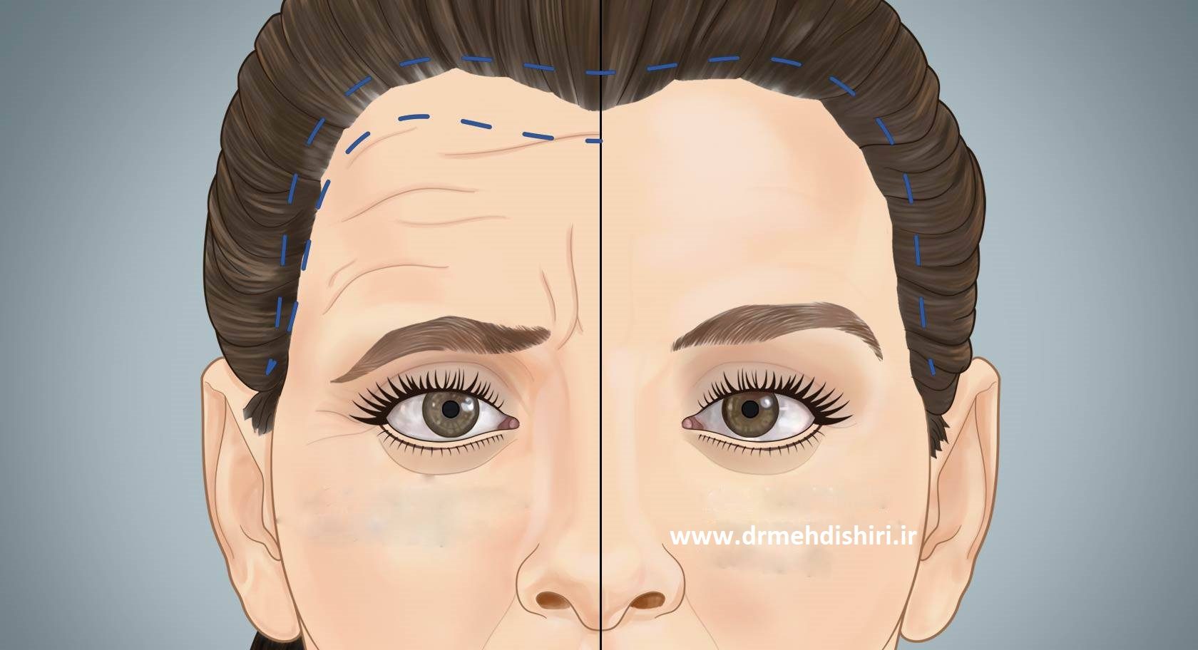 پیشانی و ابرو - دکتر مهدی شیری